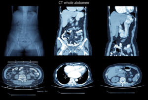 How CT scans can help diagnose and treat cancer - Orchard Imaging